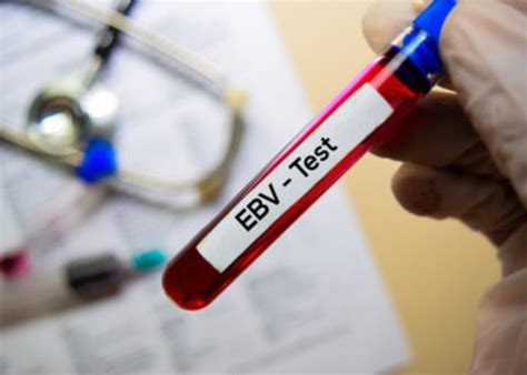 Epstein Barr Virus Likely The Cause Of Multiple Sclerosis