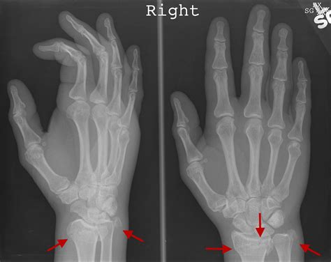 Ulnar Styloid Fracture In Distal Radius Fractures Man