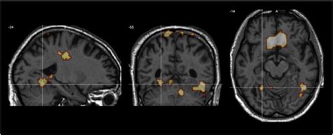 The Scenes Scrambled Scenes Contrast Shows That Only The Left Posterior Download Scientific
