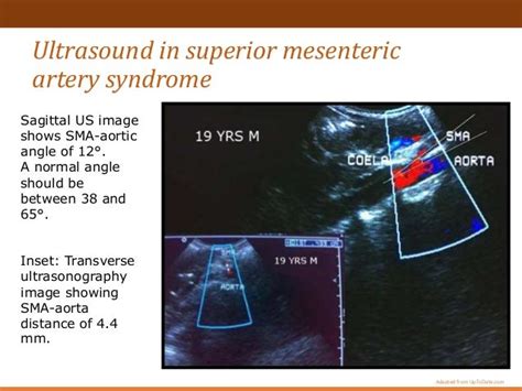 Superior Mesenteric Artery Syndrome