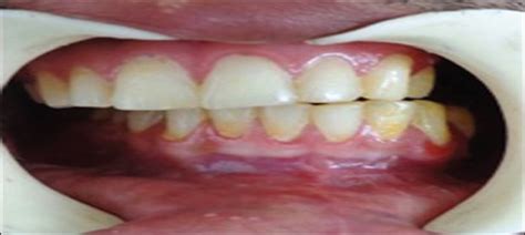 Maxillary Palatal Ramp Prosthesis A Prosthodontic Solution Contemporary Clinical Dentistry