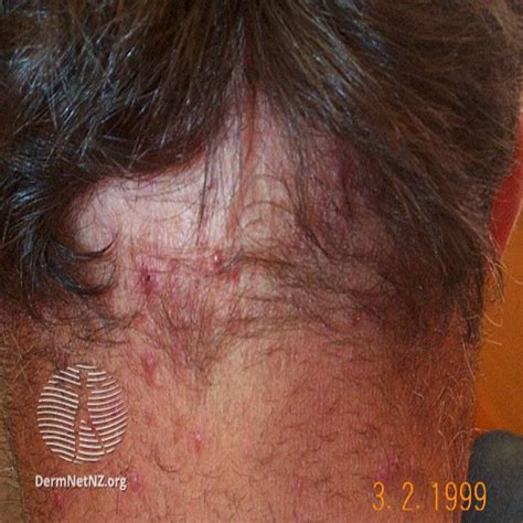 Folliculitis Detection Object Detection Dataset And Pre Trained Model By Muneeb Ur Rehman