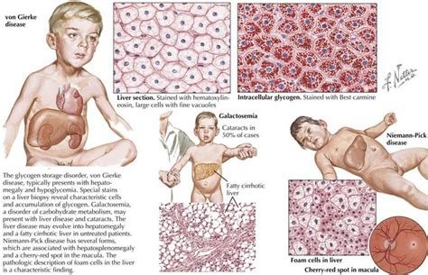 Inborn Errors Of Metabolism Clinical Gate