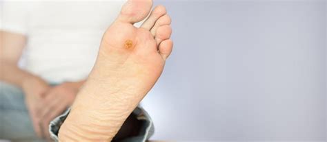 The Stages Of Toe Ulcer Healing What To Expect Washington Vascular