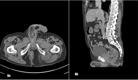 8a 2 Mm Thin Slice Axial MDCT Showing An Unusual Metastatic Deposit