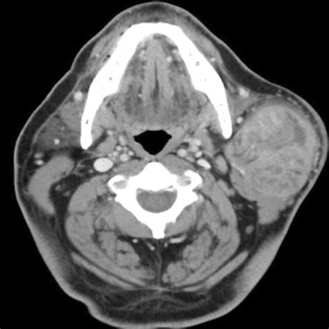 Axial Section Of Contrast Enhanced Computed Tomography Scan Showing