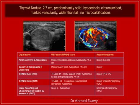 Tirads Thyroid Nodule Imaging Reporting And Data System Dr Ahmed E