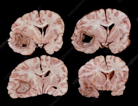 Human Brain Abscess Stock Image C057 3024 Science Photo Library