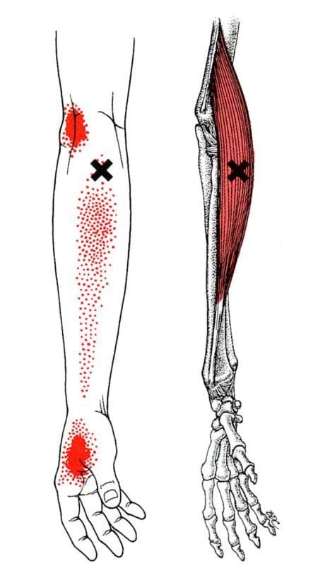 Trigger Point Affecting The Hands And Wrist El Paso Back Clinic® • 915