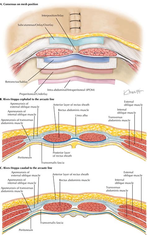 Open Retromuscular Hernia Repair Clinical Tree