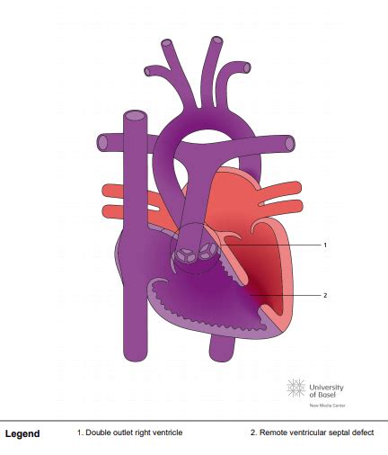 Double Outlet Right Ventricle Dorv With Remote Ventricular Septal