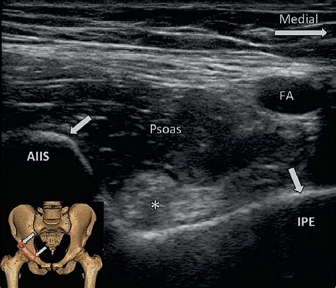 Hip Nerve Block Toolkit Canadiem