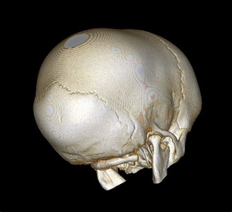 Dolichocephaly Pacs