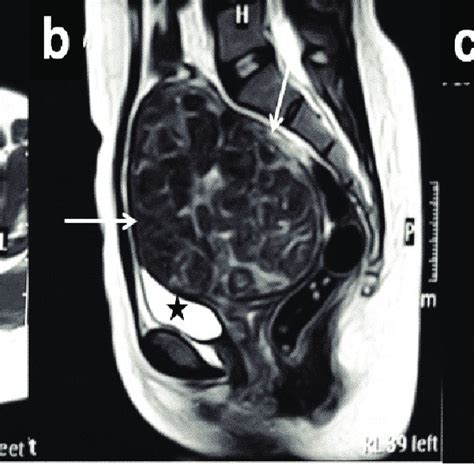 Preoperative Mri Of A Huge Anterior Cervical Myoma Occupying The Pelvic