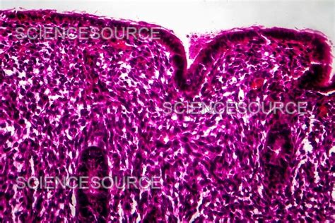 Endometrial Hyperplasia Light Microgr Stock Image Science Source Images