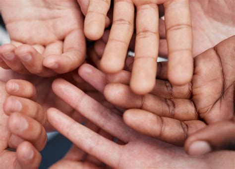 Heres My Diagnosis And Treatment For Puffy Hand Syndrome