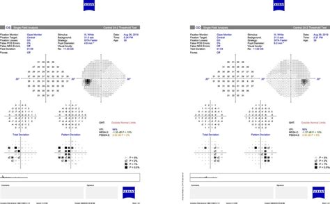 Humphrey 24 2 Visual Field Illustrating Enlarged Blind Spots With