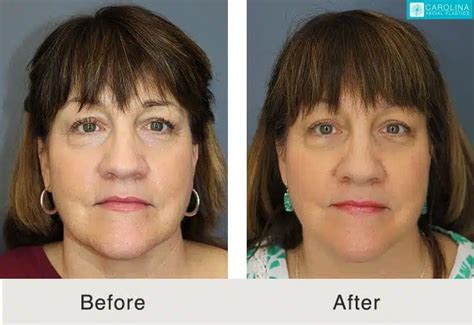 Non Surgical Neck Lift In Charlotte Nc Carolina Facial Plastics