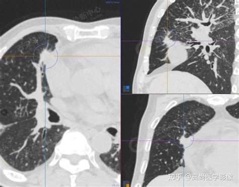 Pet Ct