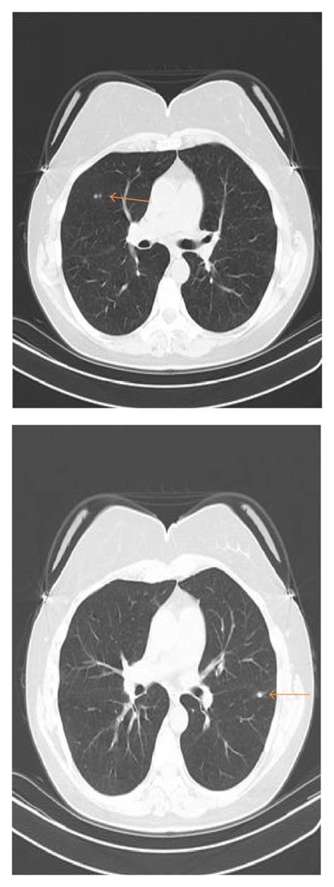 Chest Ct Scan Revealing Bilateral Nodules Download Scientific Diagram