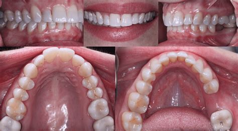 I Like To Move It Move It In Office 3d Printed Aligners With Archform And Moonray Digital Enamel