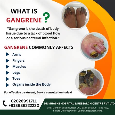 What Is Gangrene Gangrene Is The Death Of Body Tissue Due To A Lack Of