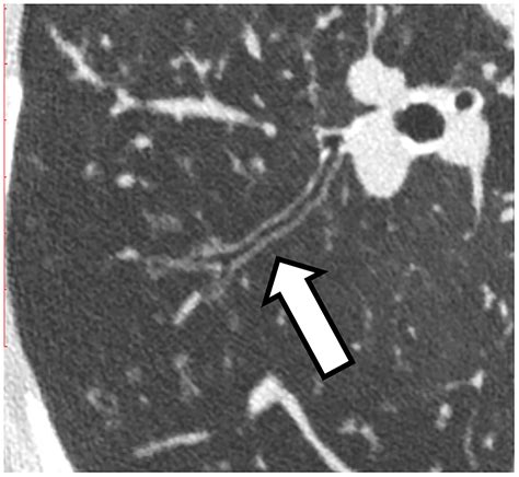 Clinical Applications Of Photon Counting Detector Ct Pmc