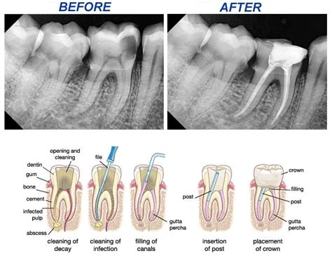 Root Canal Therapy Modesto Endodontics Treatment