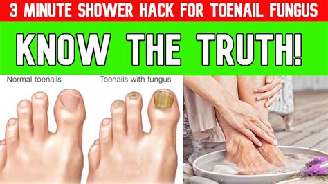 3 Minute Shower Hack For Toenail Fungus Kerassentials Oil Nail