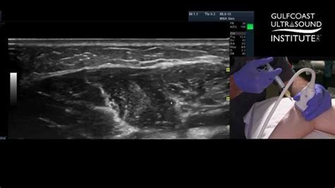 How To Hydrodissect And Block The Ulnar Nerve Using Ultrasound Guidance