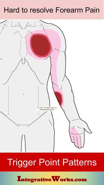 Hard To Resolve Forearm Pain Integrative Works