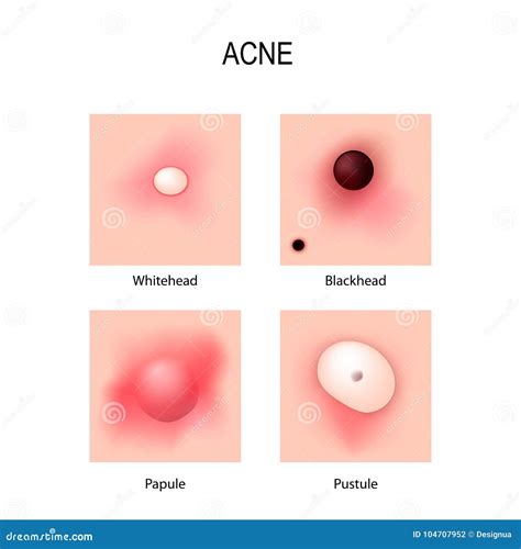 Acne Vulgaris Stages Of Development Types Of Pimples Stock Vector Illustration Of Acne