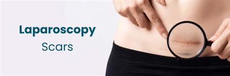 Laparoscopy Scars Its Factors Affecting And Its Prevention