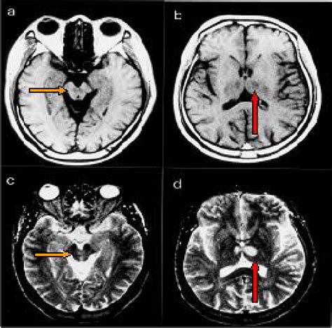 Magnetic Resonance Images Show Acute Bilateral Infarctions Of The