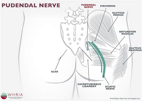 Bilateral Pudendal Nerve Block