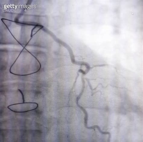 Coronary Angiogram After Open Heart Surgery Of Right Coronary Artery