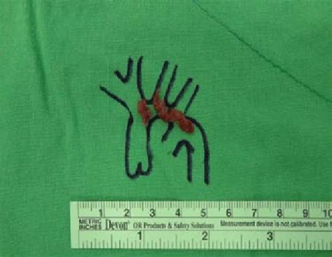 Thrombus In The Aortic Arch Download Scientific Diagram