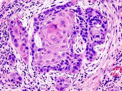 Ent Blogs Verrucous Carcinoma Ackerman Tumour
