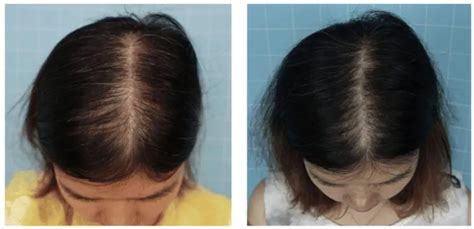 Minoxidil Timeline How Long Does Minoxidil Take To Work