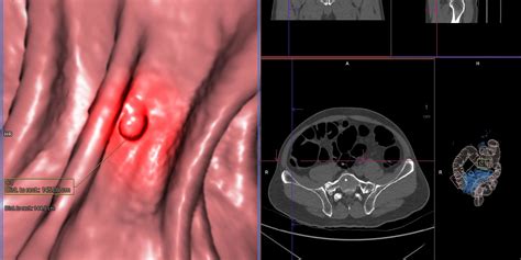 Ct Colonography Breakthrough The Imaging Wire