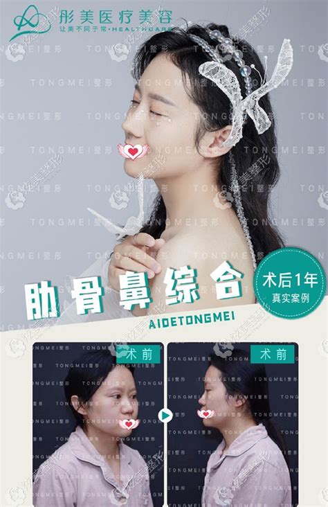 北京李长赋做鼻子多少钱 10万够做肋骨鼻综合手术不 隆鼻手术 炫美网
