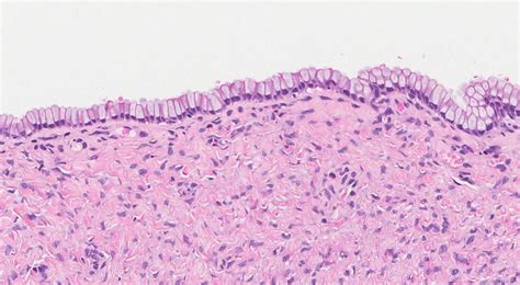 Mucinous Cystadenoma Of The Ovary Ottawa Atlas Of Pathology