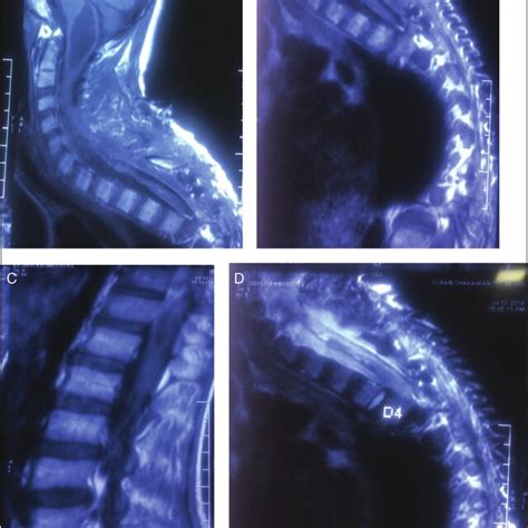 Postoperative Magnetic Resonance T1 Weighted A C And T2 Weighted