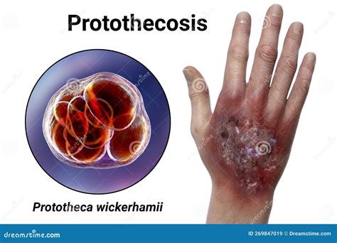 Protothecosis Infection On Human Hand And Close Up View Of Prototheca Wickerhamii Green Algae