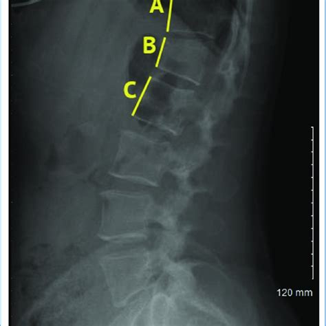 Patient With L Compression Fracture Anterior Percentage Compression Download Scientific