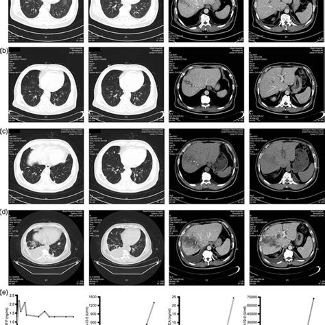 Chest Computed Tomography Showed An Intraluminal Nodule Chest Computed