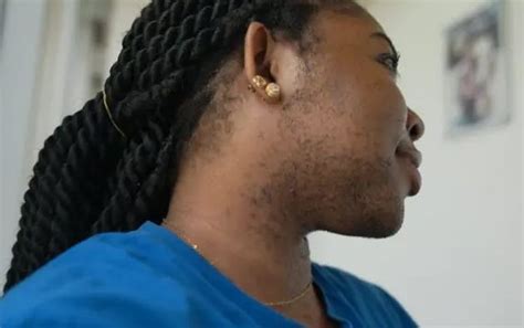 Explainer What To Know About Excessive Hair Growth In Women