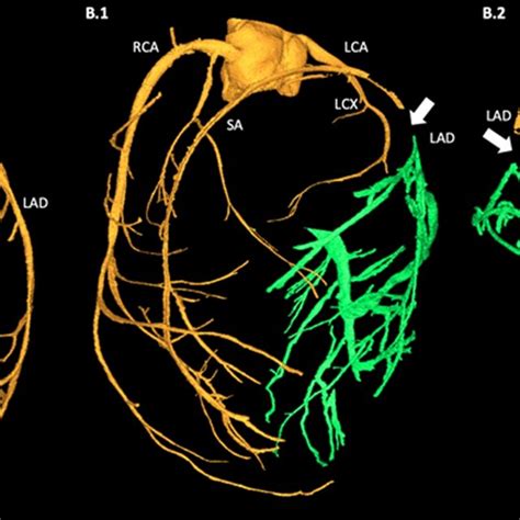 3d rendering of the segmented vascular tree for this rendering one