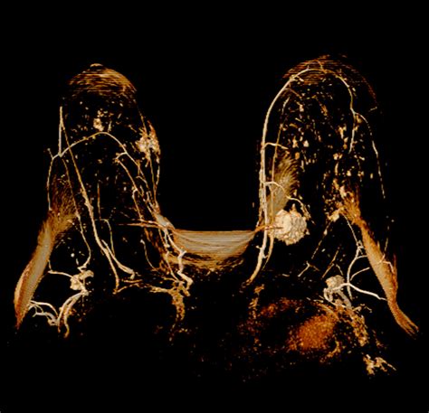 Breast Imaging Courses Radiology Resident Core Lecture Series