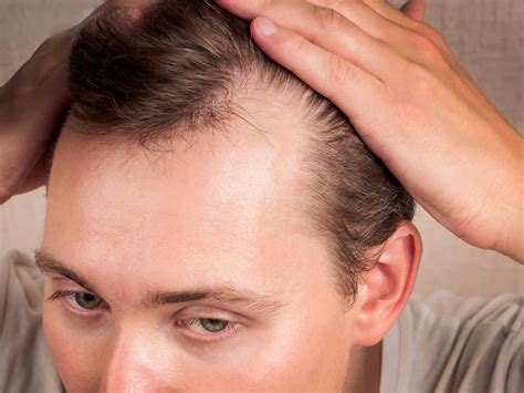 11 Receding Hairline Treatments For Men